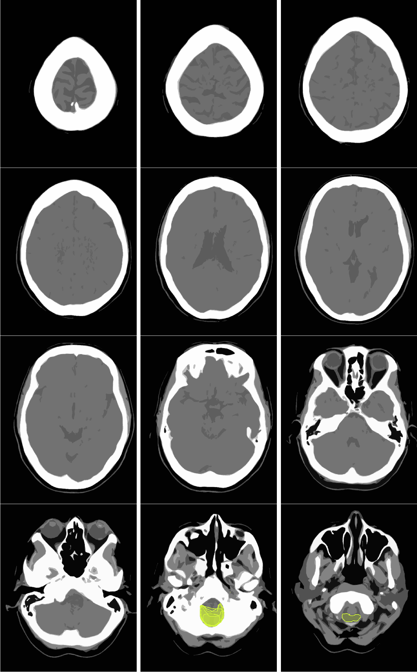 MissMap-CT Head-Other